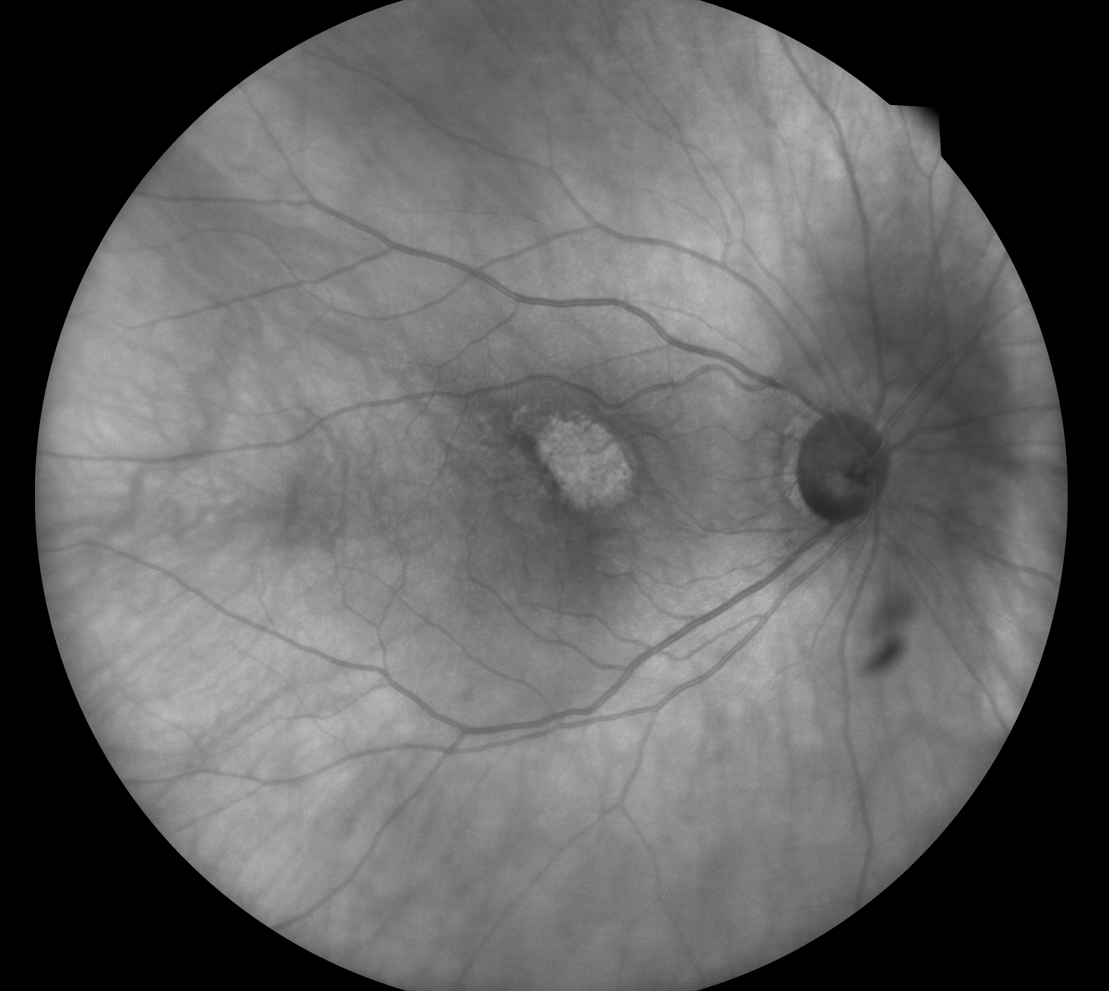 IR imaging | Retina & Eidon