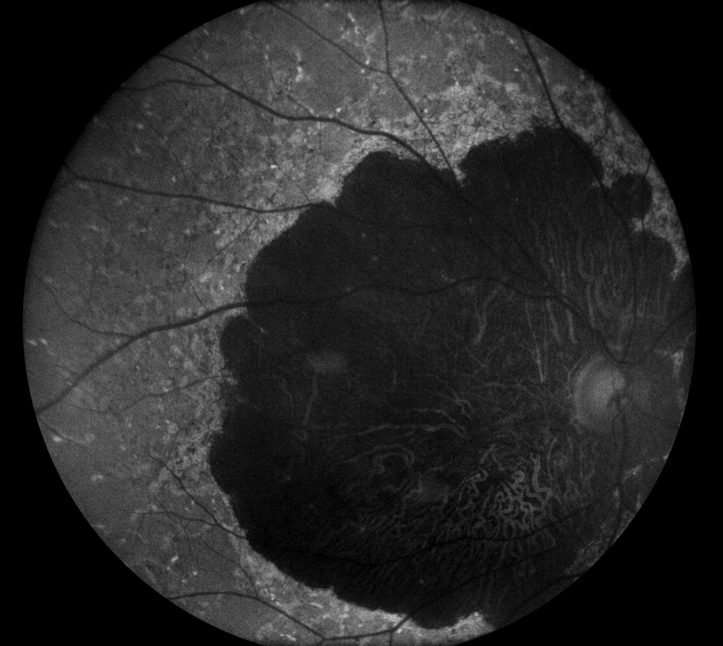 Retinal artery occlusion(Eidon)