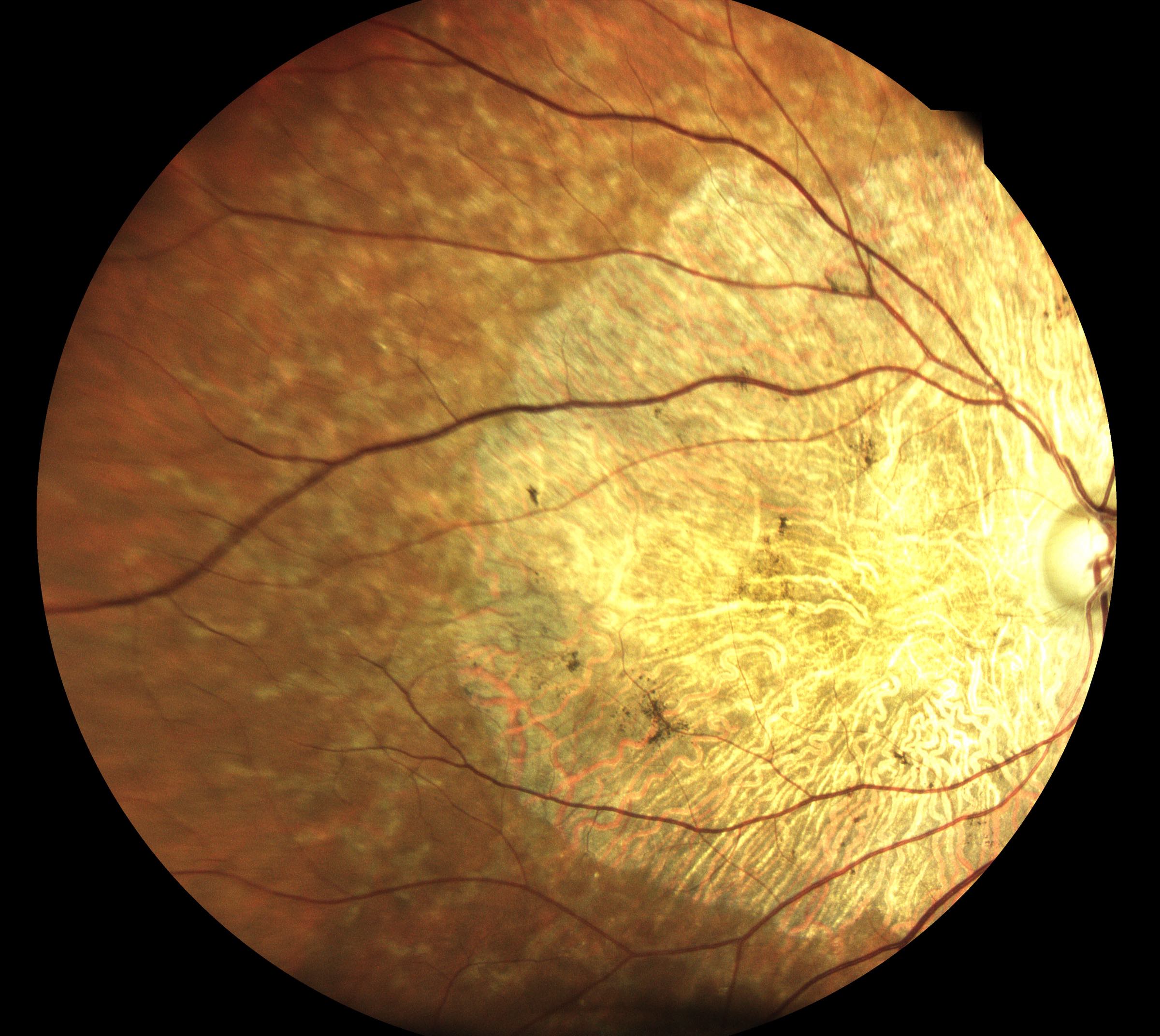 Retinal artery occlusion(Eidon)