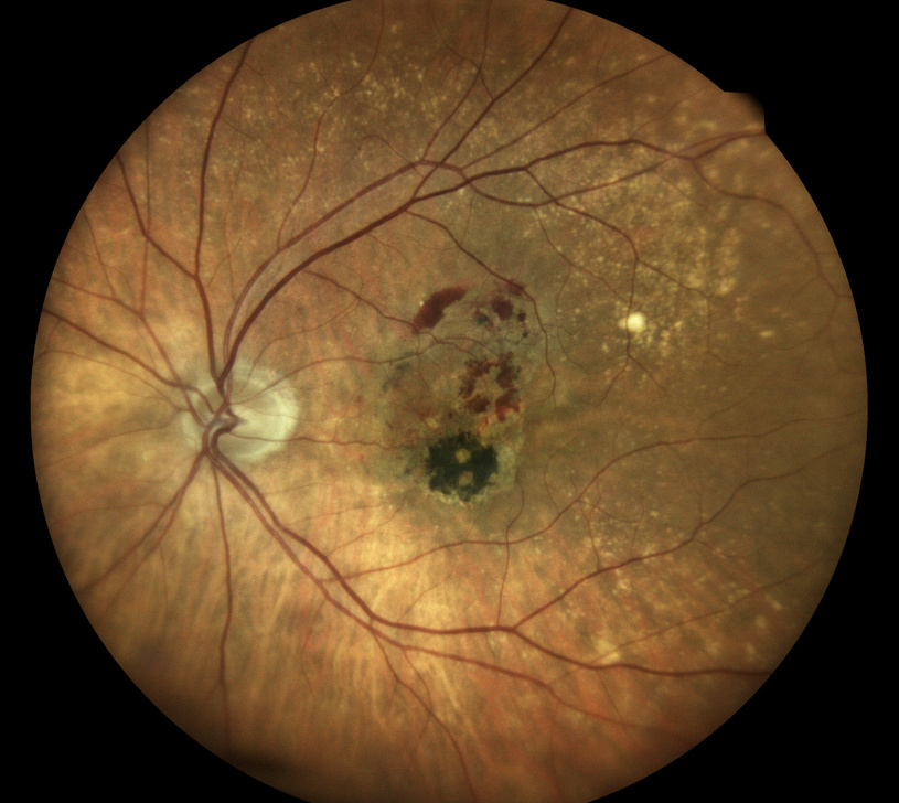 Eidon, multimodal retinal imaging