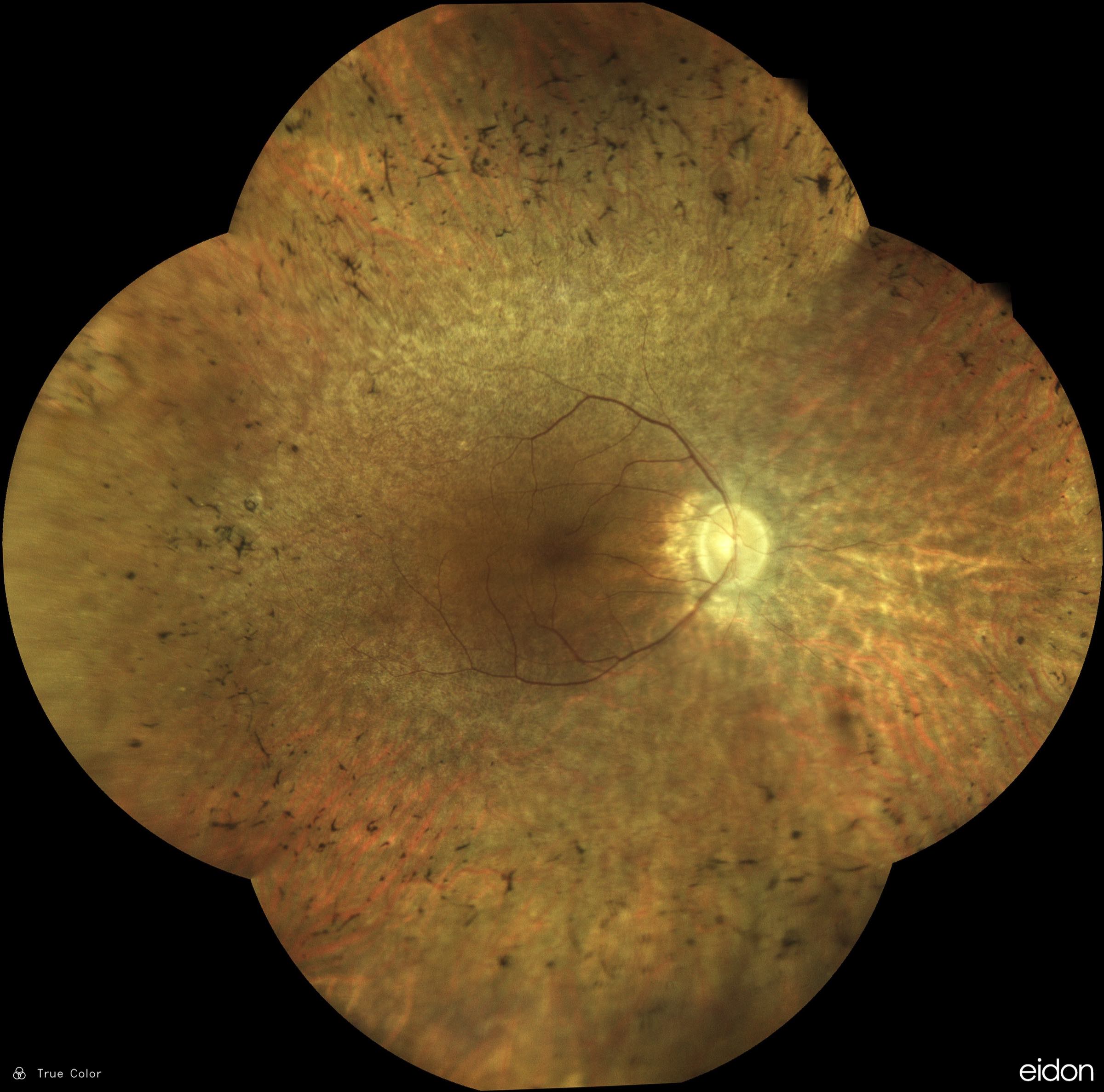 Retinitis Pigmentosa (Eidon)