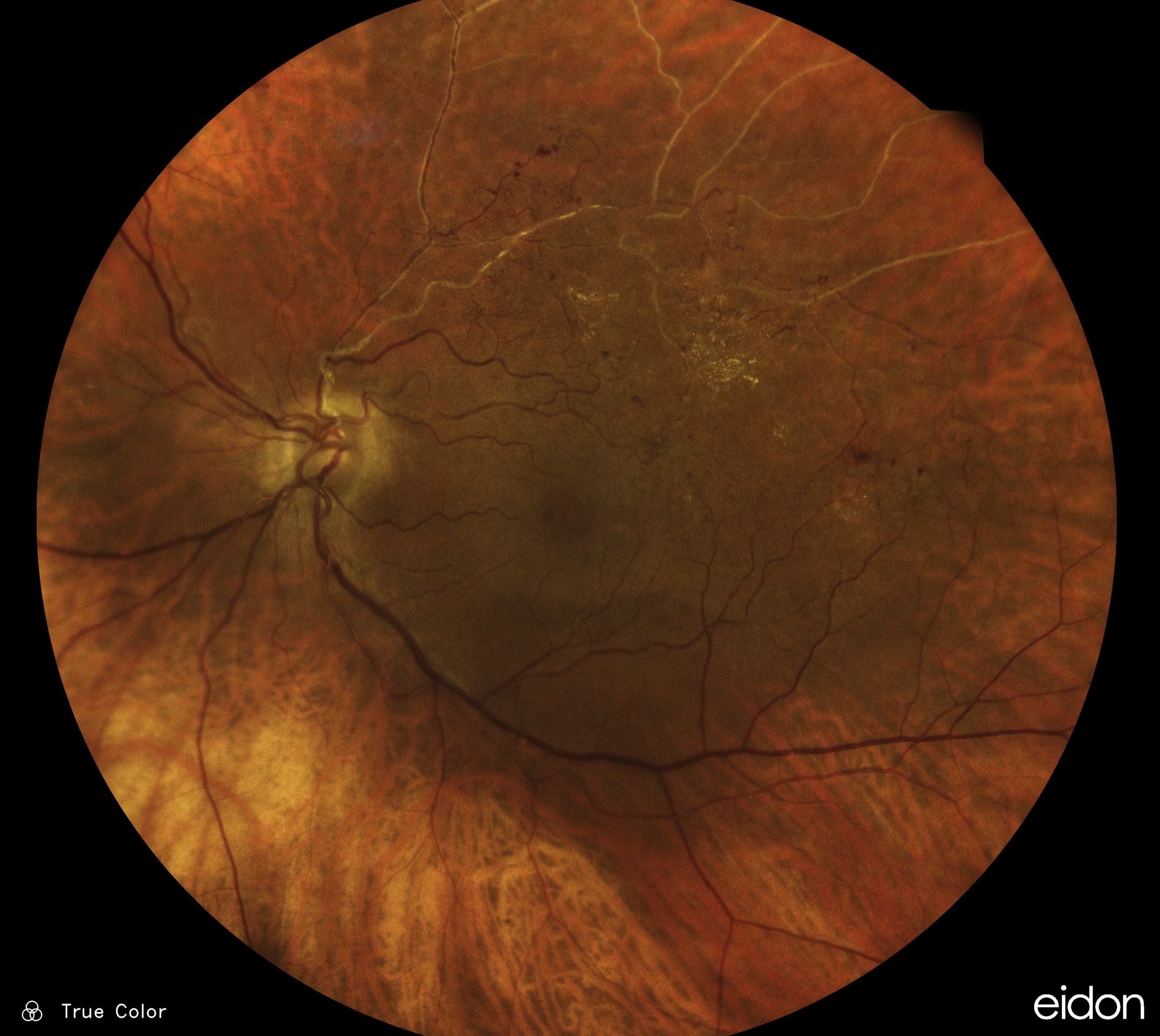 Retinal venous occlusion(Eidon)